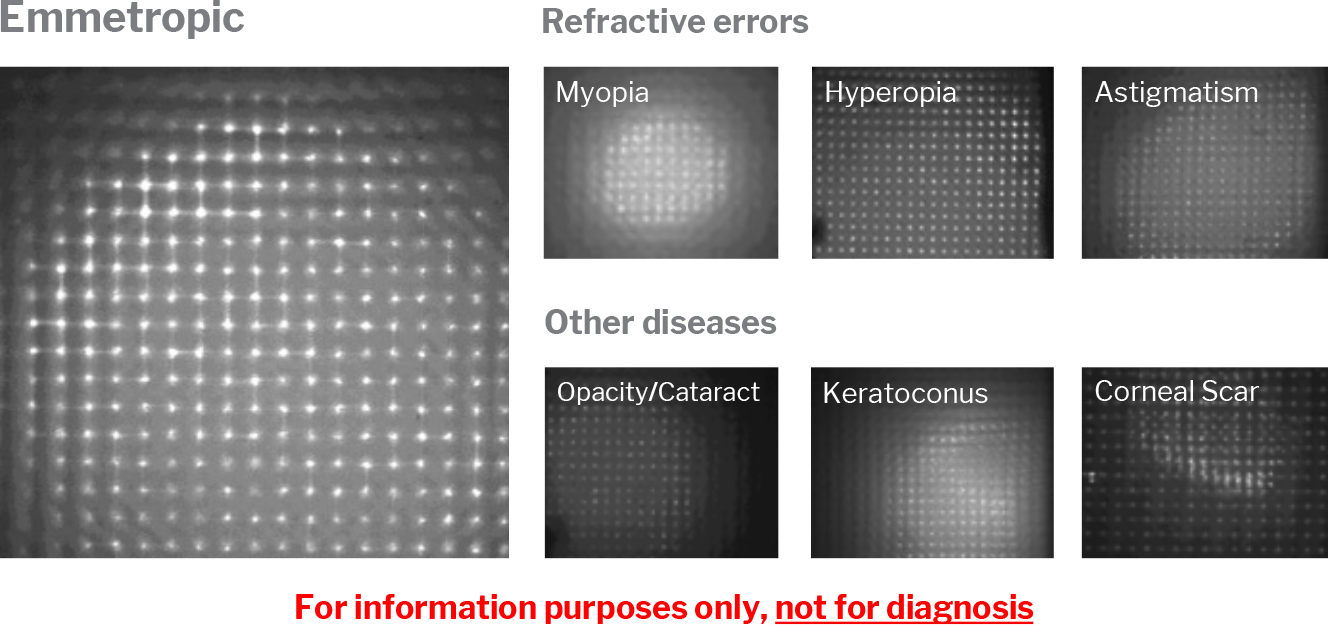 How wavefront aberrometry improves autorefraction | QuickSee Free Pro ...